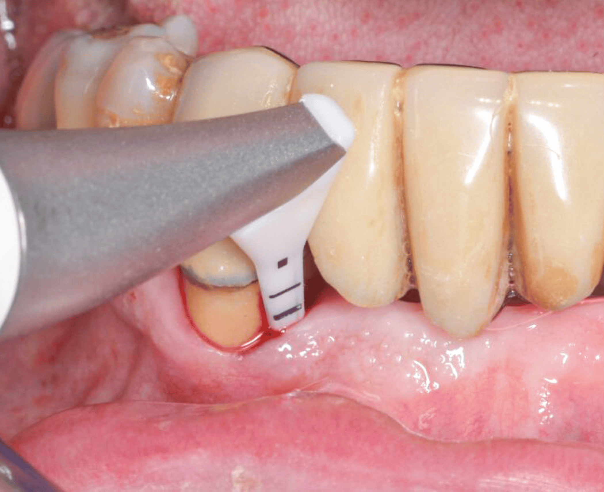 Parodontologie non chirurgicale | Formation E-learning DPC