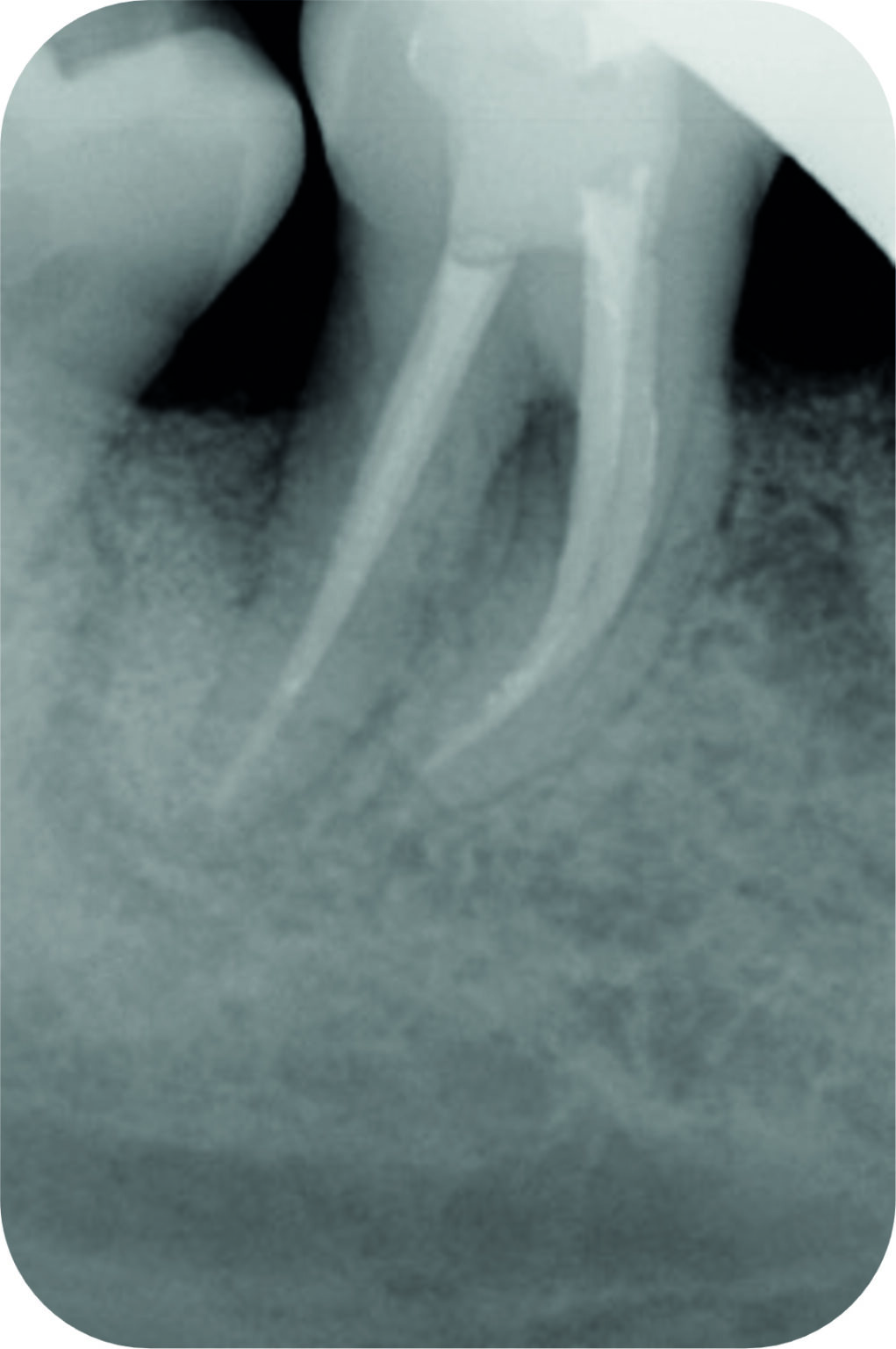 Reconstitutions corono-radiculaires : vers un changement de paradigme ...