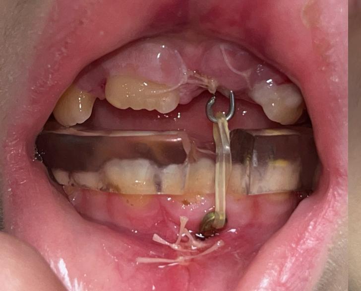 Diagnostic et gestion de l’ankylose et du Défaut Primaire d’Eruption (DPE)